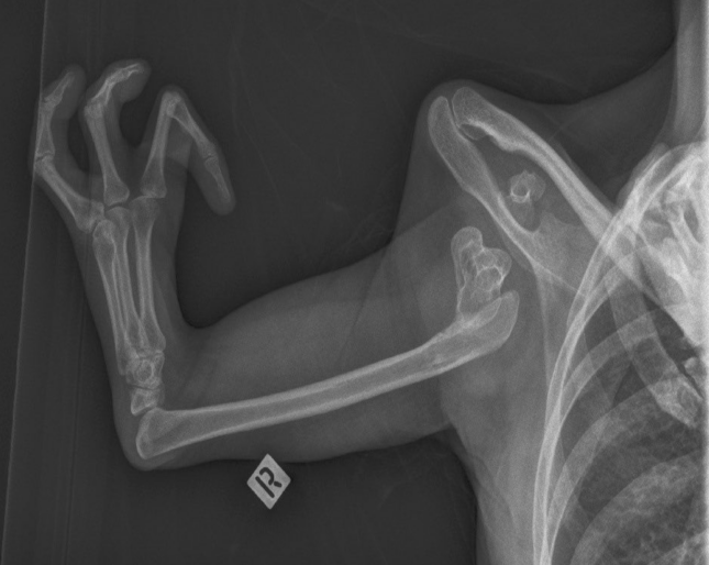 Hvad er Thalidomid? – De Thalidomidskadede